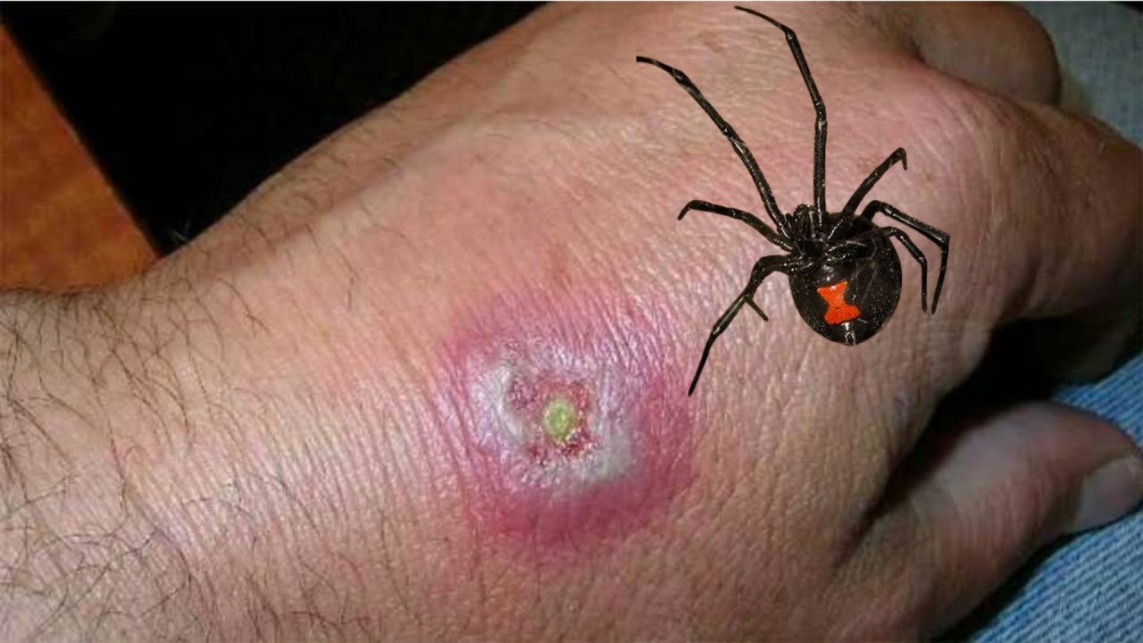 black widow spider bite pictures & symptoms - Spider Pedia